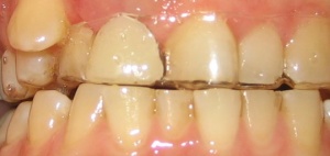 My Tooth Implant - stacky wiki