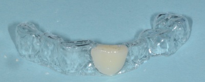 My Tooth Implant - stacky wiki